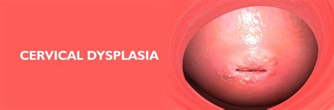 Cervical Dysplasia Symptoms Causes And Treatment Options