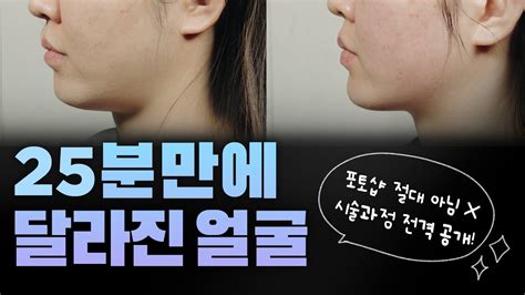 25분만에 바뀌는 얼굴 시술로도 가능합니다 리얼한 시술과정 공개 👀 트루스컬프 슈링크유니버스 Youtube