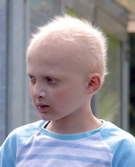 Ectodermal Dysplasia Syndrome Related Healthjournals Ectodermal