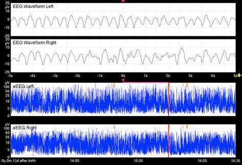 Seizures In Preterm Infants Without The Raw Eeg The Hypersynchronous Download Scientific