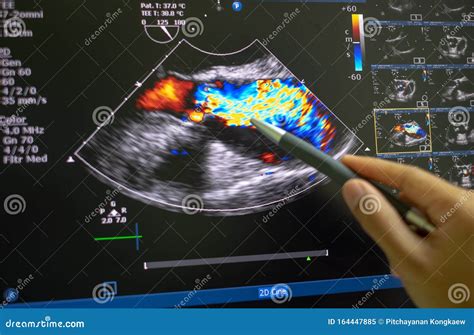 Echocardiography Ultrasound Machine Stock Image Image Of Doppler Diacnosis 164447885