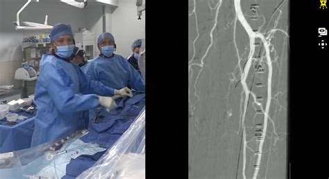 Sfa Cto Revascularization With Concurrent Btk Cto Ccc Live Cases