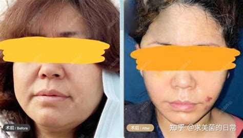 圣嘉新宋超超面部提升手术传统拉皮手术与第四代拉皮手术技术的优劣比较 知乎