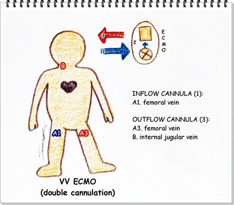 Crash Ecmo The Scrub Nurse