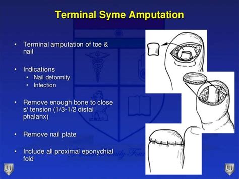 Amputation Toe Cpt Code