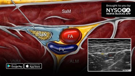 Nerve Block Tip Of The Week Adductor Canal Block Nysora