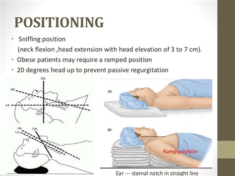 Rapid Sequence Induction And Intubation