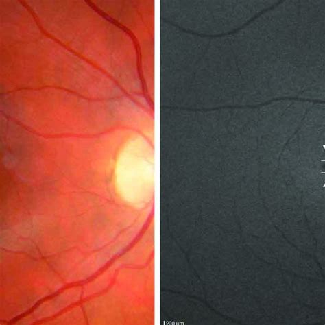 Pdf Eclipse Retinopathy Injury Scale Eris A Classification Of