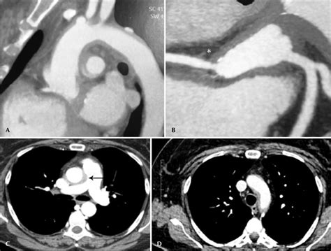 Multi Row Detector Computerized Tomography Angiography There Is A Download Scientific Diagram