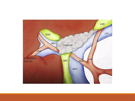 Hilar Cholangiocarcinoma Pptx