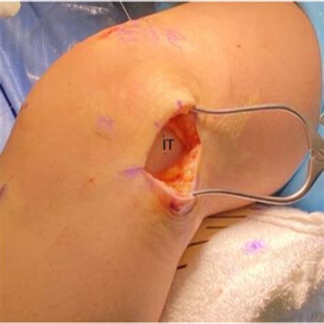 Left Knee Open View Demonstrating The Lateral Knee With The Knee