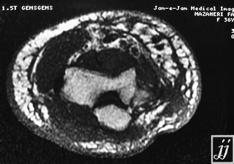 Subcutaneous Cellulitis And Lymphatic Edema After Axially And Breast Surgery Radiopaedia