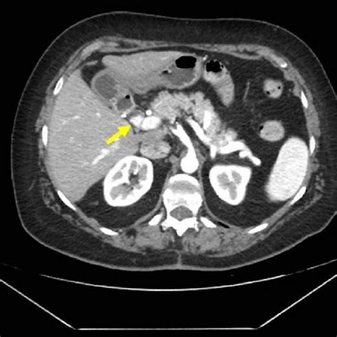 Representative Cut Of The Computed Axial Tomography Of The Abdomen