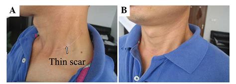 Neck Dissection Operation Neck Cancer Resection And Dissection Utxhf