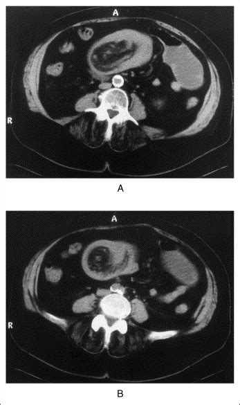 Jejunojejunal Intussusception Secondary To Adenocarcinoma The