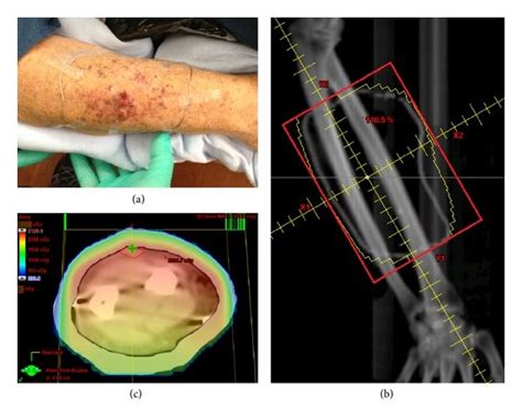 Secondary Cutaneous Plasmacytoma Presenting As A Nodularity On Patchy