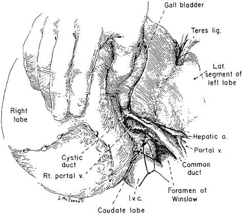 Hepatic Trisegmentectomy And Other Liver Resections Pmc