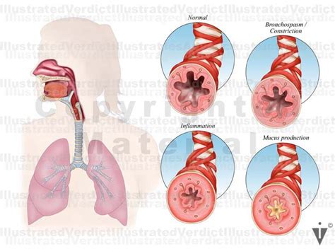 Stock Lungs Disorders Ards Copd Asthma Bronchitis Pneumonia