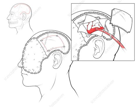 Decompressive Craniectomy Illustration Stock Image C036 5319 Science Photo Library