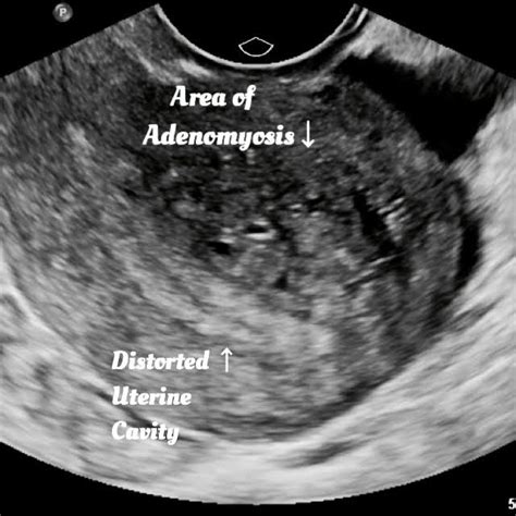 Adenomyosis Symptoms Causes And Treatment Ultrasoundfeminsider