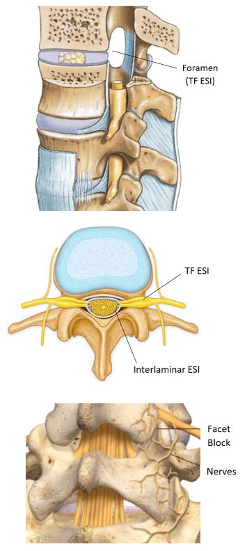 Injection Types Excel Spine