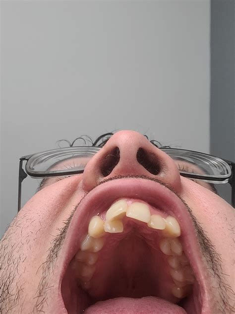 2 Upper Premolar Extraction For Braces Rorthotropics