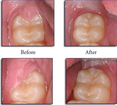 Caredent Patient Education Operculectomy