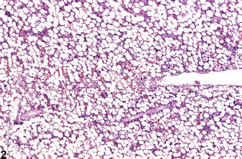 Bone Marrow Hypocellularity Nonneoplastic Lesion Atlas