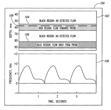 Doppler Ultrasound Patented Technology Retrieval Search Results