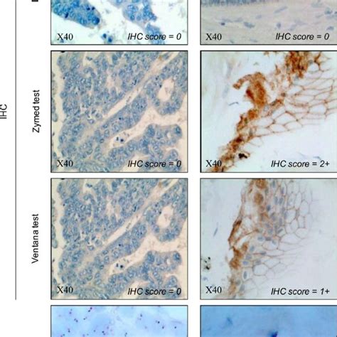 Representative Egfr Staining Pattern In Tumor Sample Defined As