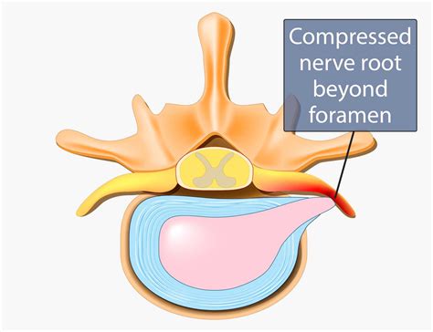 intervertebral foramen nerve