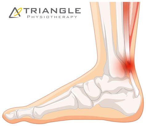 Achilles Tendonitis Treatment Triangle Physiotherapy