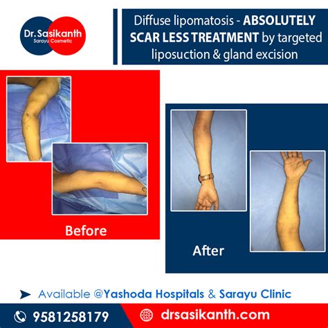 Diffuse Lipomatosis Is A Condition Dr Sasikanth Maddu