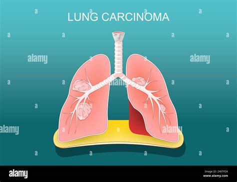 Lung Carcinoma Lung Cancer Tumors Metastasize Spreading To Other Parts Of The Body Vector