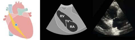 Echo Basics Tricuspid Valve • Litfl • Radiology Library