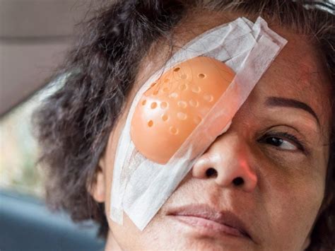 How Long To Wear Eye Makeup After Cataract Surgery Saubhaya Makeup