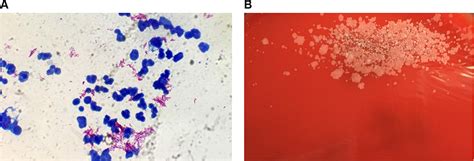 Cutaneous M Abscessus Infection Following Plastic Surgery Ccid