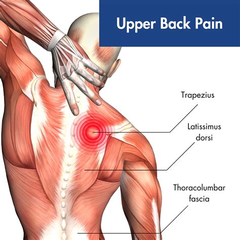Most Common Upper Back Muscle Injuries