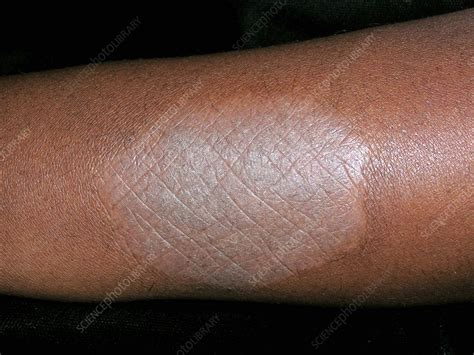 Lichen Simplex Chronicus Stock Image C056 0995 Science Photo Library