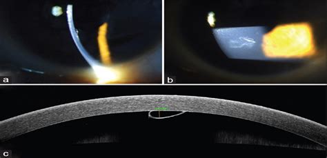 Retained Anterior Lens Capsule Fragment Mimicking Descemet M Indian Journal Of