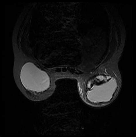 Breast Implant Rupture Pacs
