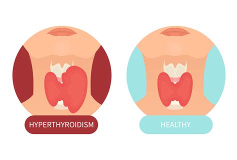 Underactive And Overactive Thyroid Hypohyperthyroidism Underactive And Overactive Thyroid Hypohyperthyroidism