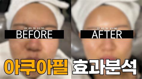 아쿠아필 어디까지 알아봤어요ㅣ효과 완전 분석｜피부 트래블러 피부과 전문의 노성민 Youtube