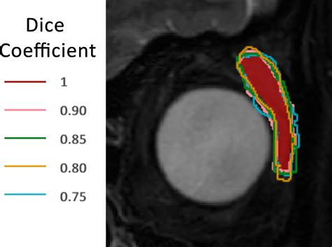 Figure 1 From Gray Level Discretization Impacts Reproducible Mri Radiomics Texture Features