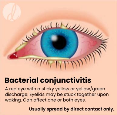Viral Conjunctivitis Discharge Conjunctivitis Nhs