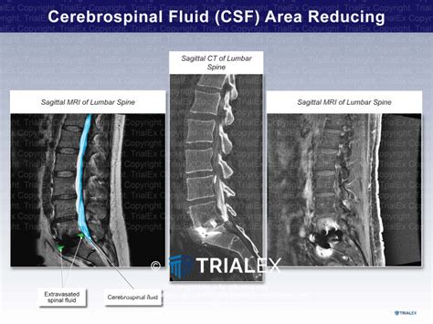 Cerebrospinal Fluid CSF Area Reducing TrialQuest Inc