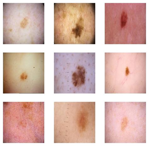 Getting Started With Kaggle Competitions Melanoma Classification Challenge Jay Gala