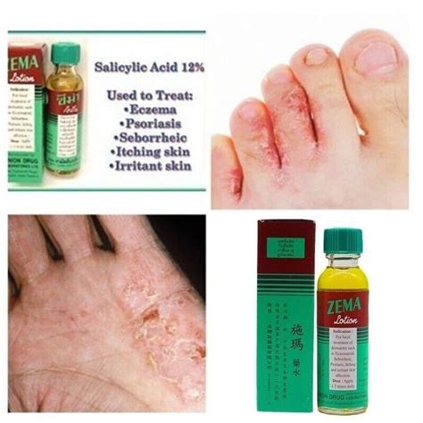 ZEMA lotion Treatment Dermatitis Eczematoid Psoriasis 12% Eczema Itchy ...