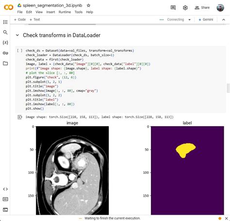 Spleen 3d Segmentation Monai Bhandit Thathasut
