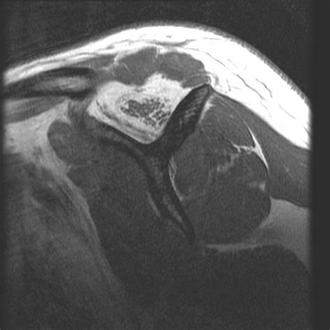 Supraspinatus Muscle Atrophy Grading Mri
